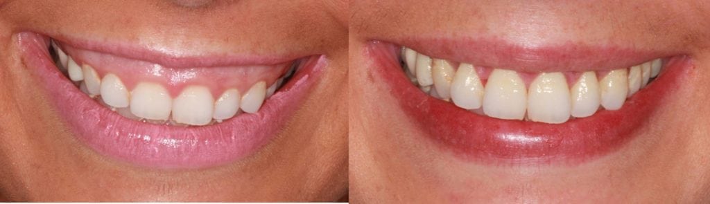Cosmetic Crown Lengthening Procedure - Alabamaperiodontics.com
