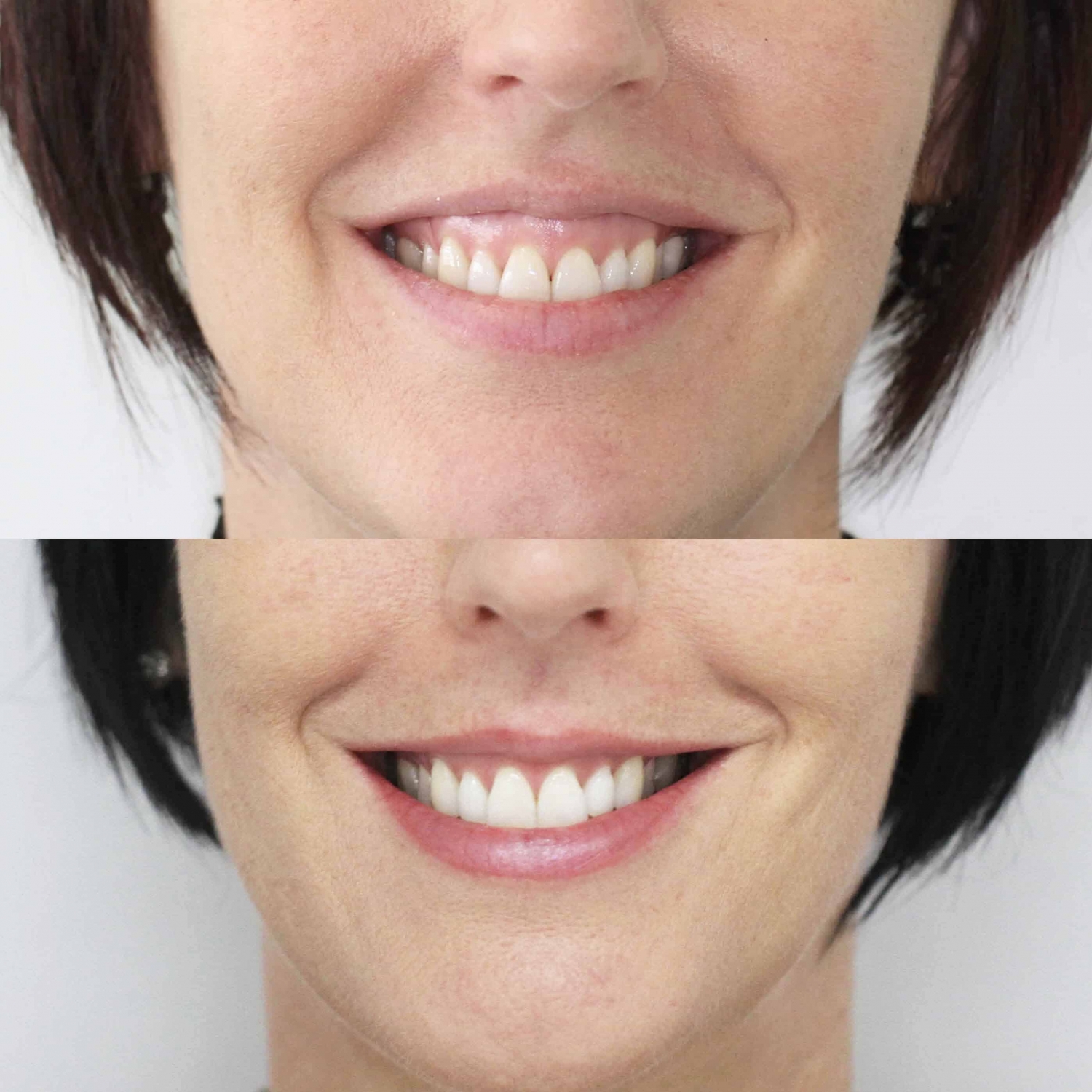 Gum Lift Birmingham, AL | Gum Recontouring - Periodontist in Birmingham ...