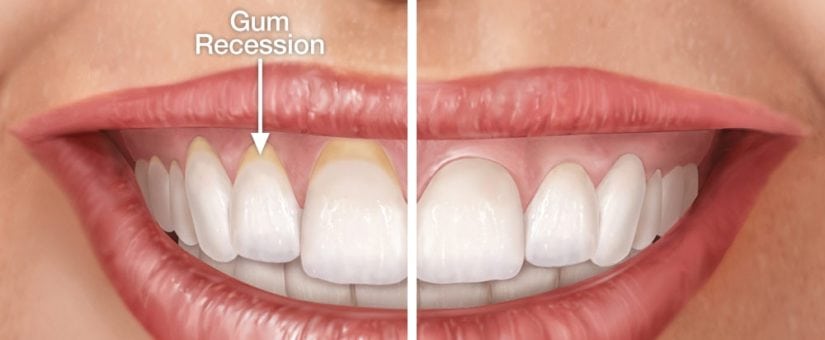 Stages Of Gum Disease - Periodontist in Birmingham, AL - Gum Disease ...