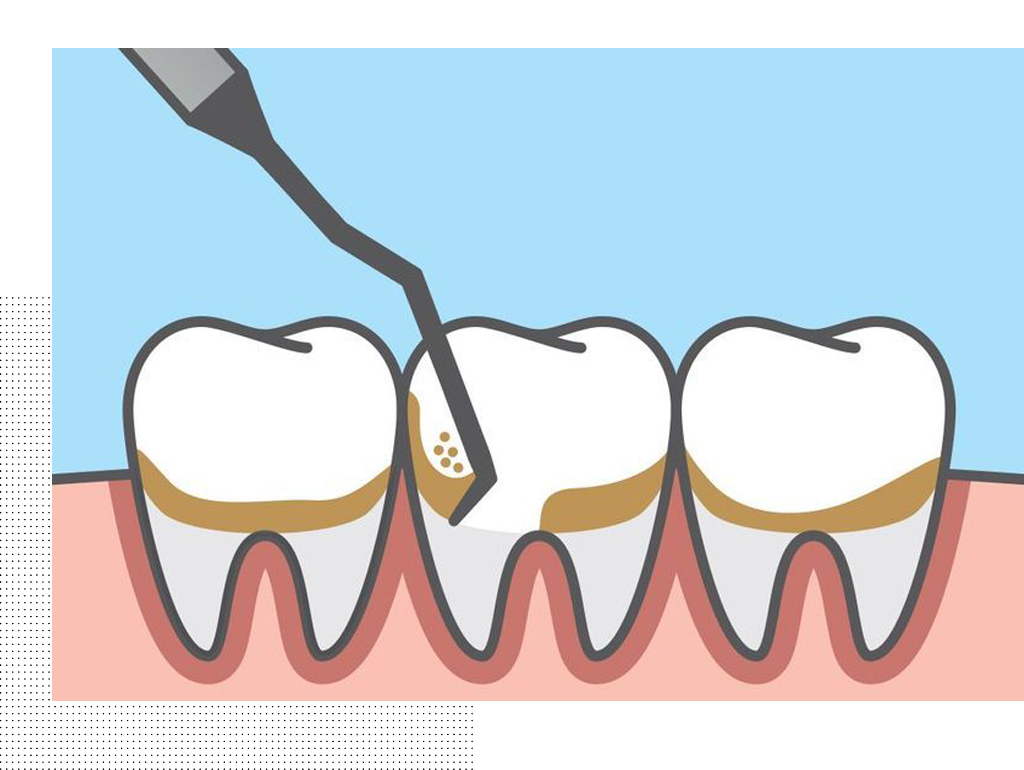 Deep Cleaning, Periodontal Scaling and Planing in Birmingham, AL ...