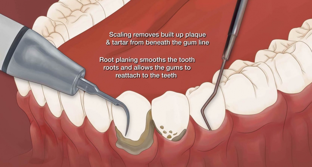 Scaling And Root Planing Periodontist In Birmingham AL Gum Disease
